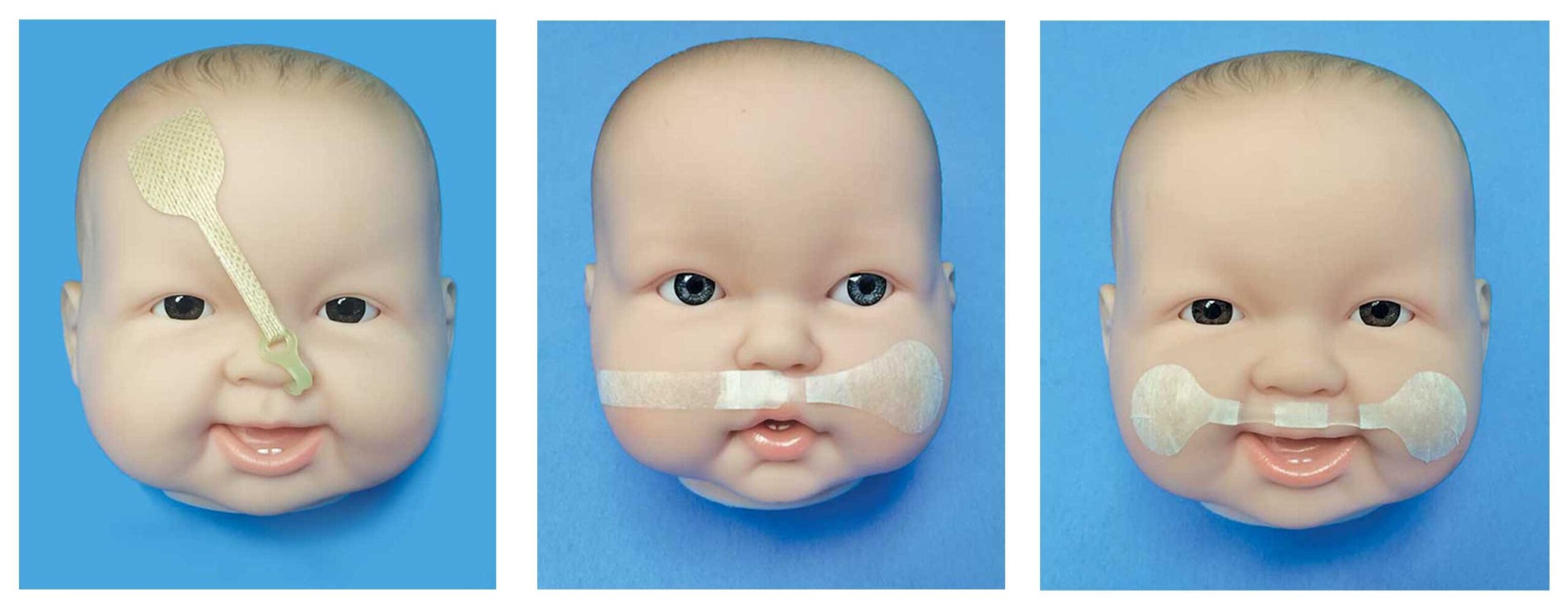 London Cleft Lip & Palate - Role of Classification Consistency